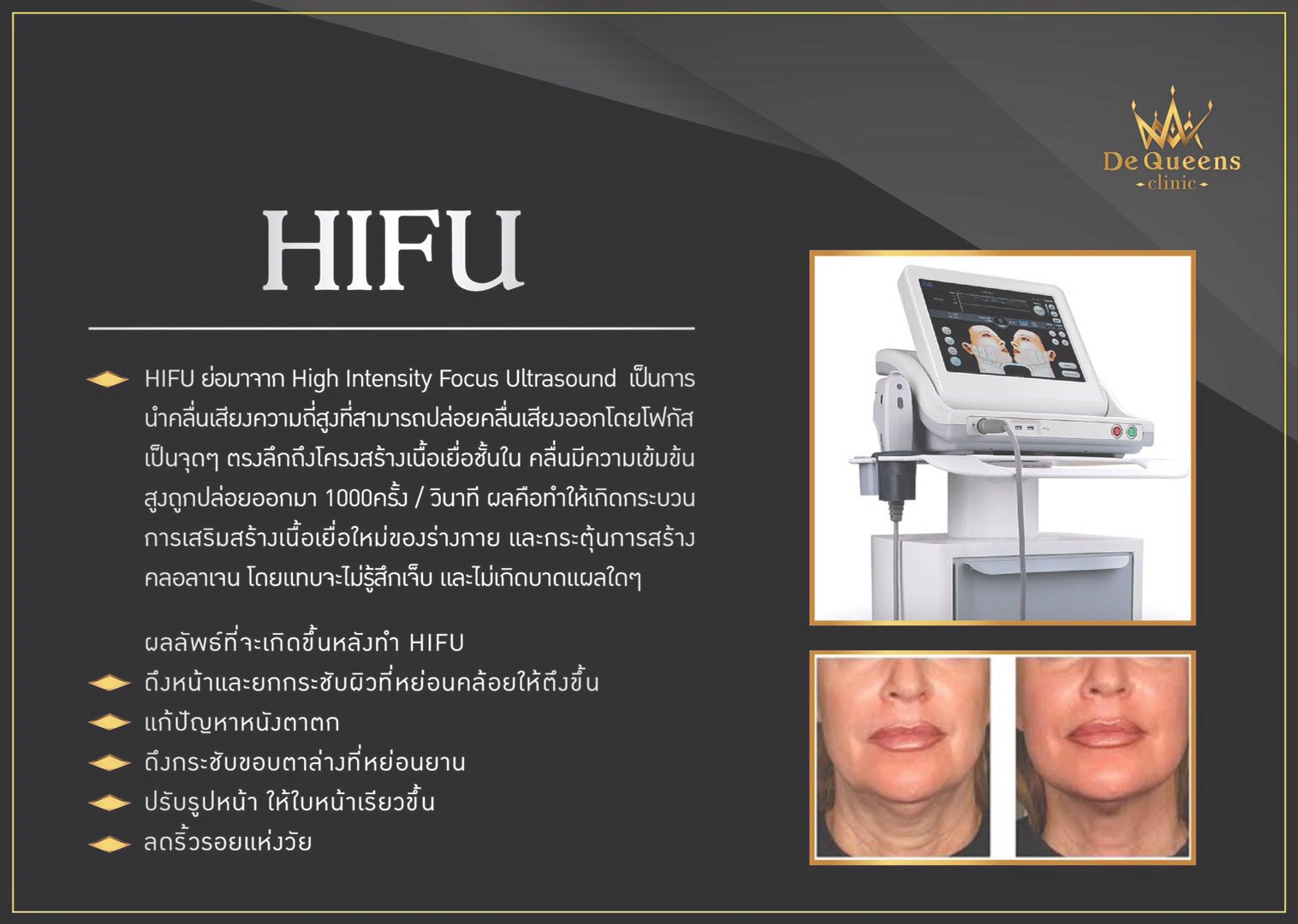 Ultra Max Lift ยกกระชับ